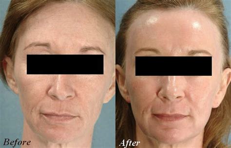 Active Fx Gallery Before And After Photos Laser Cliniqúe