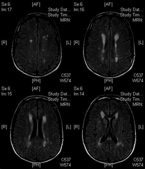 2 Brain Mri Of A Patient With Cadasil Note The Extensive Download Scientific Diagram