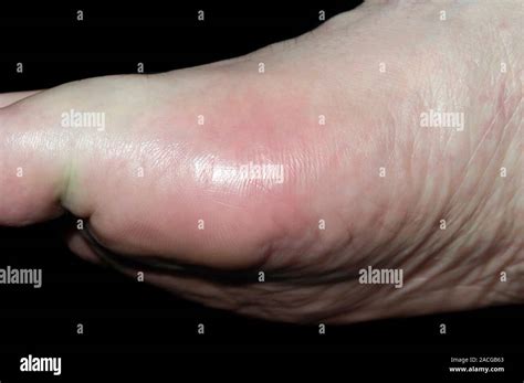 Redness Around The Joint Showing Acute Gout Of The Big Toe In An 81