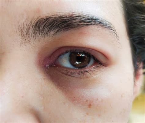 4 Causes Of A Red Bumpy Nose