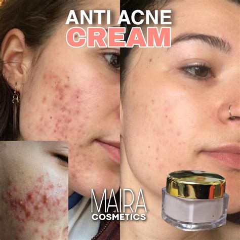 Anti Acne And Pimple Cream 30gm Maira Cosmetics Store