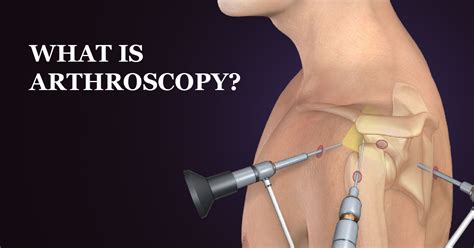 What Is Arthroscopy Welcome To Sys Medtech International Pvt Ltd What Is Arthroscopy Welcome To Sys Medtech International Pvt Ltd