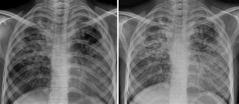 Chest X Ray Tb Vs Normal
