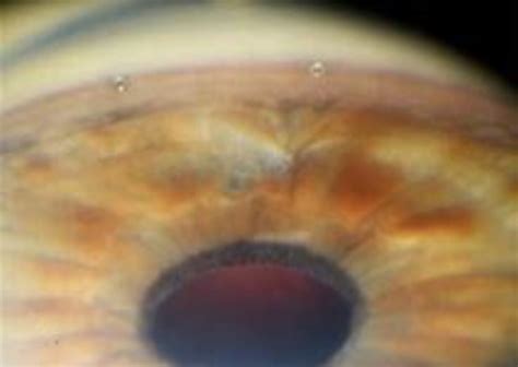 Glaucoma Cataract Surgery The Istent Procedure Eye Glaucoma Cataract Surgery The Istent Procedure Eye