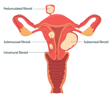 What Are Uterine Fibroids