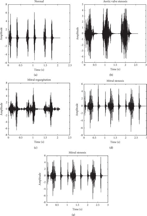 Figure 1 From A Computer Aided Heart Valve Disease Diagnosis System