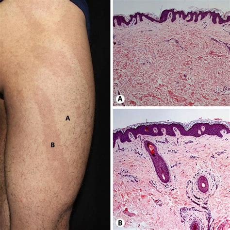 The Patient Presented Hyperpigmented And Rough Bands Following A