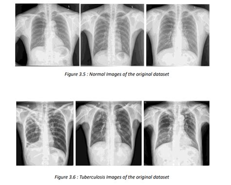 GitHub Sadeepi Pulmonary Tuberculosis Desease Detection