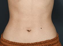 Before After Belly Button Revision Before And After Photo Gallery
