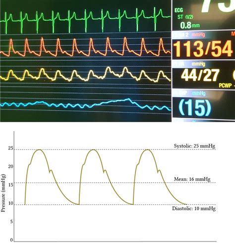Pulmonary Artery Catheter Waveforms