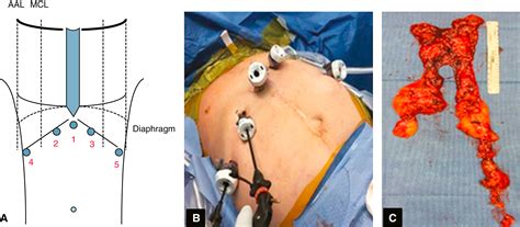 Subxiphoid Subcostal Versus Transthoracic Thoracoscopic Thymectomy A Safe And Feasible Approach