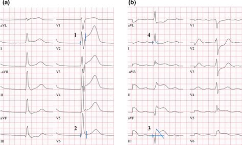 Electrocardiography Examples From A Patient With A Lad Occlusion A Download Scientific