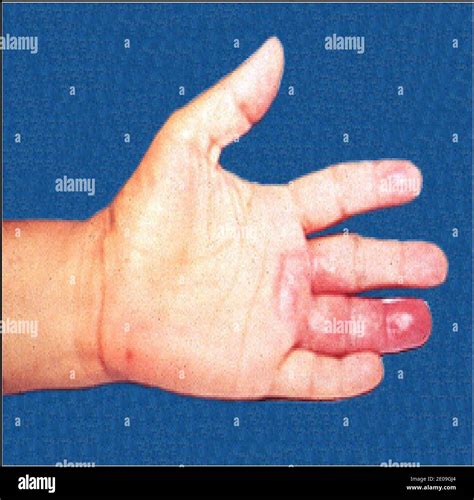 Leprosy Disease Before And After