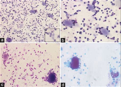 Cytopathological Examination Of Bronchoalveolar Lavage Fluid In