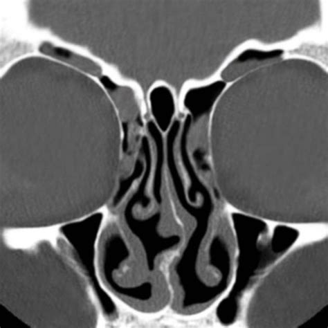 A Caldwell Radiograph Showing Opacification Of Frontal And Ethmoidal