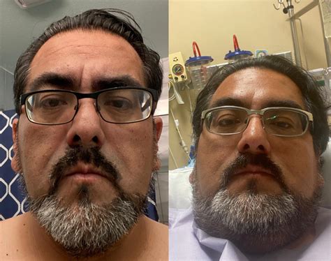 16 Week Post Surgery Thoughts Rbariatricsurgery