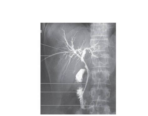 Percutaneous Transhepatic Cholangiography