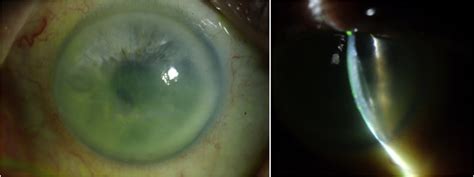 Descemet Membrane Detachment” A Novel Concept In Diagnosis And