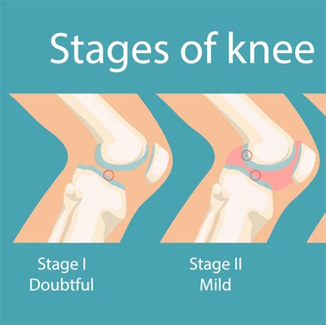 Annotated Dataset For Knee Arthritis Detection領 Kaggle