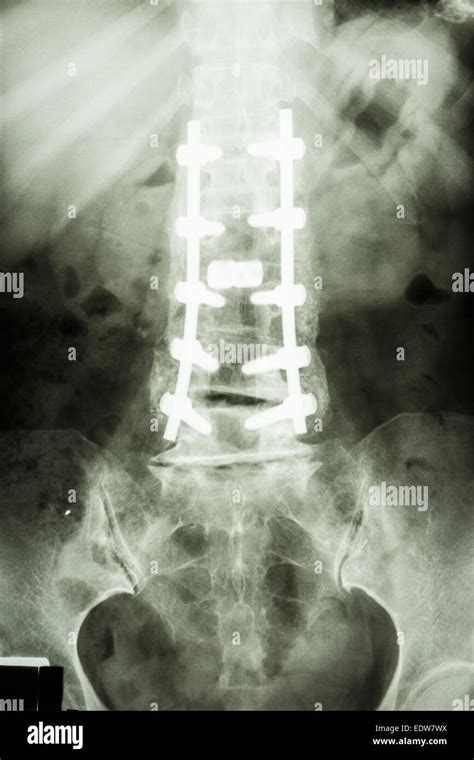 Film X Ray Show Lumbar Spine With Pedicle Screw Fixation In