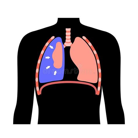 Pneumothorax Anatomical Poster Stock Vector Illustration Of Physical