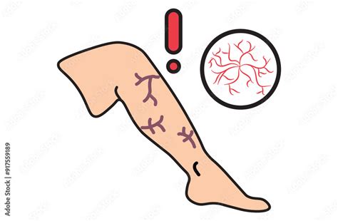 A Venous Leg Ulcer Is A Chronic Slow Healing Sore On The Lower Leg