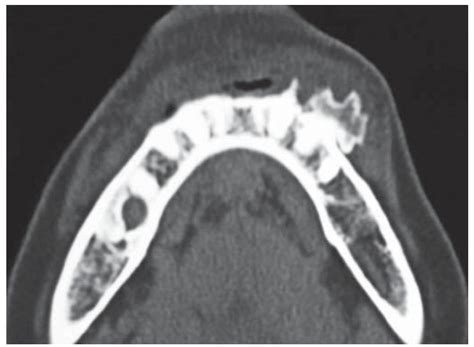 Exophytic Bony Lesion On Left Body Of Mandible In Continuity