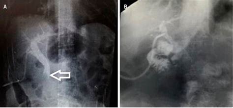 Choledocholithiasis Ercp