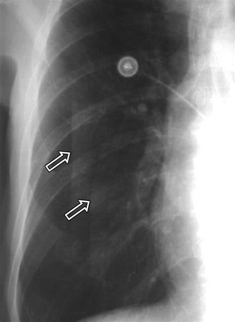 Pulmonary Hyperlucency In Adults Ajr