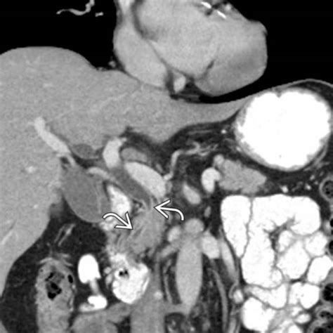 Autoimmune Igg4 Cholangitis Radiology Key