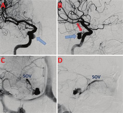 Dsa Revealed A Type B Ccf On The Right Side A In The Anteroposterior Download Scientific Dsa Revealed A Type B Ccf On The Right Side A In The Anteroposterior Download Scientific