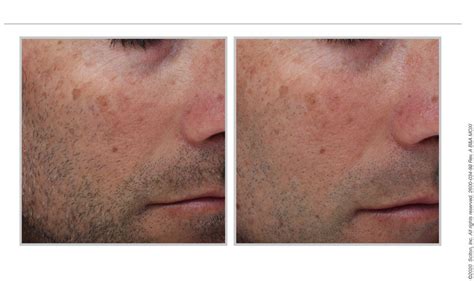 Moxi Laser Sydney Infinity Skin Clinic