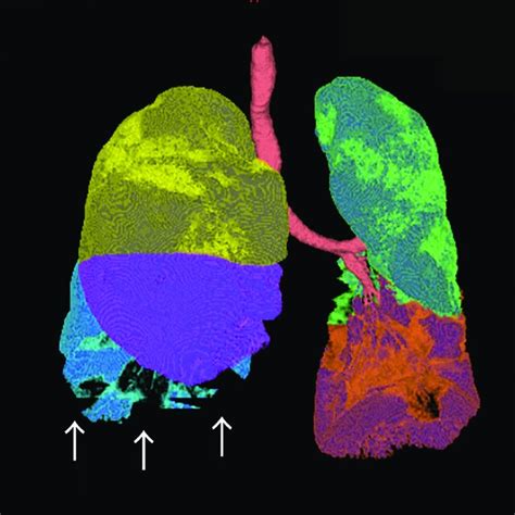 Dorsal Subpleural Consolidations Are Not Recognized As Part Of The Lung