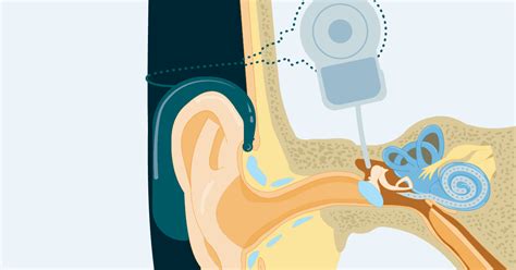 How Many Electrodes Are In A Cochlear Implant At Margaret Goldsberry Blog