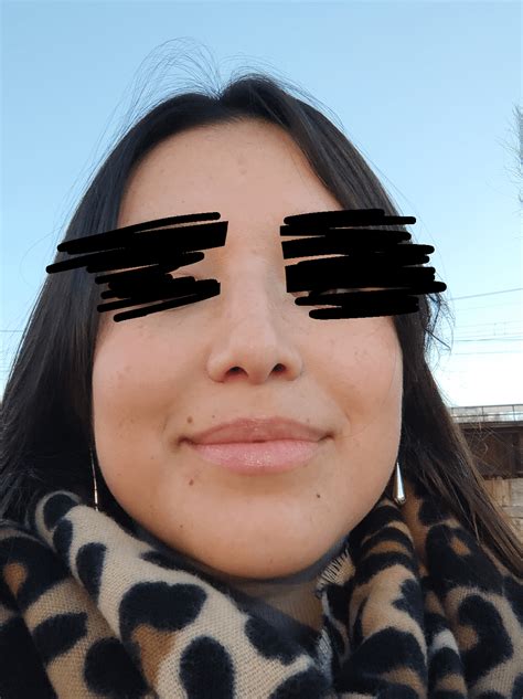 Deviated Septum Rplasticsurgery