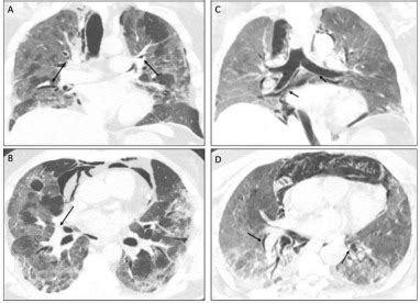 The Macklin Effect Closely Correlates With Pneumomediastinum In Acutely