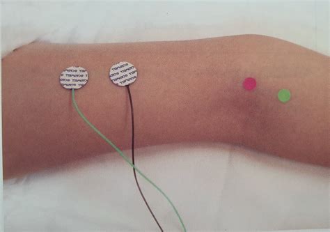 신경전도검사 Median Nerve정중신경 검사방법 피할 수 없으면 즐기자