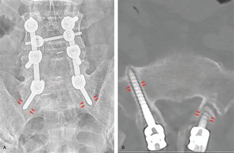 Level Based Analysis Of Screw Loosening With Cortical Bone Trajectory