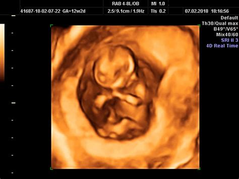 What You Should Expect At 12 Weeks Pregnant Pregnancy