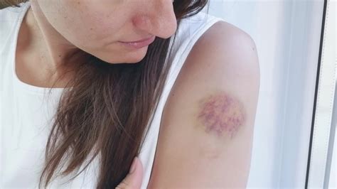 A Woman In A White T Shirt By The Window Touches A Large Bruise On Her