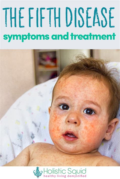 Fifth Disease Erythema Infectiosum Fifth Disease Symptoms And