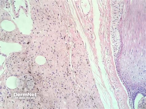 Neurocristic Hamartoma Image