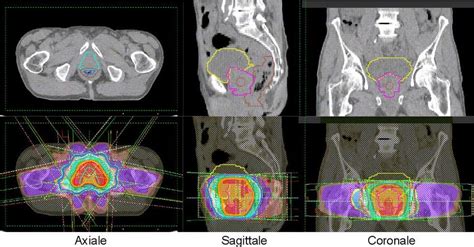 4 Above Main Structures Prostate Bladder And Rectum In Three