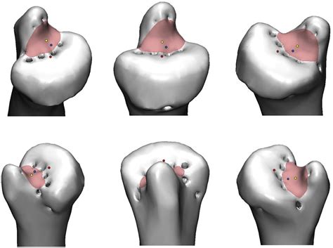 Morphology Of The Ulnar Insertion Of The Triangular Fibrocartilage Complex And Related Osseous