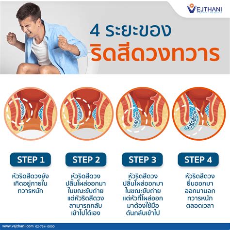 Internal Hemorrhoids Banding