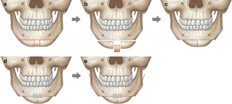 The V Line Surgery Narrowing Genioplasty With Mandible Reduction