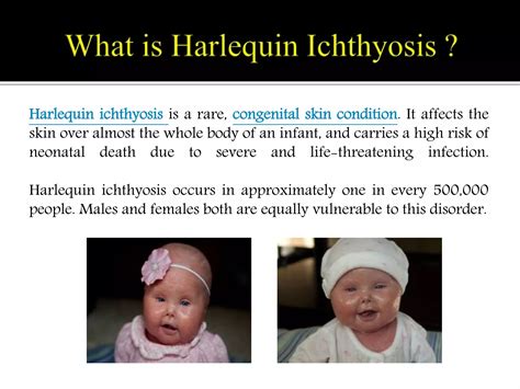 Harlequin Ichthyosis Causes Symptoms Complications And Treatment Pptx