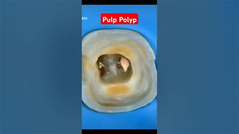 Pulp Polyp Treatment Youtube