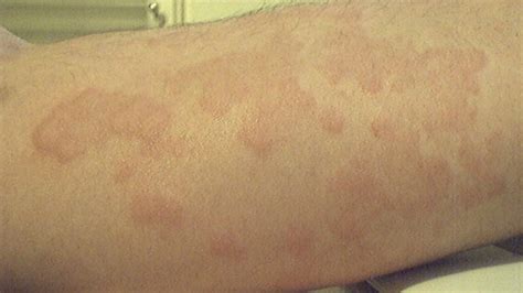 Hives Causes Risks Prevention And Pictures