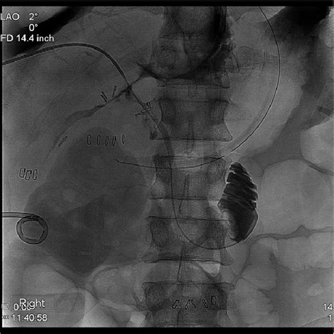 Percutaneous Transhepatic Cholangiogram With Wire Traversing Into The